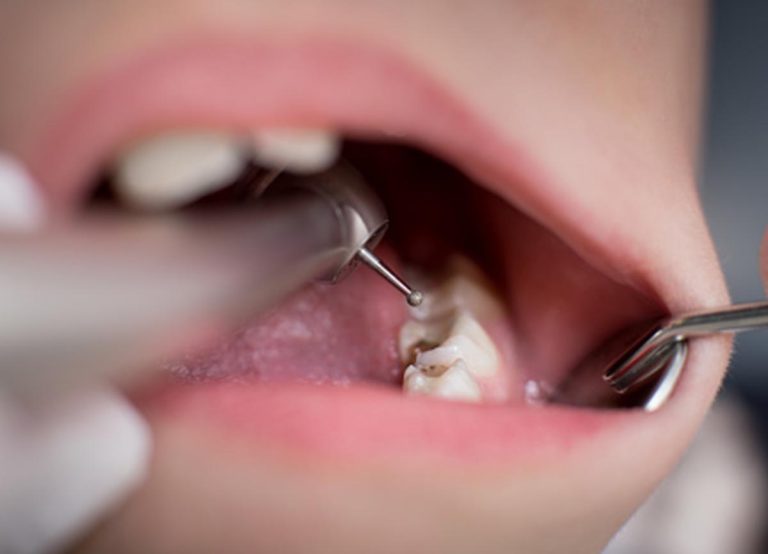 Filling – St pauls Dental